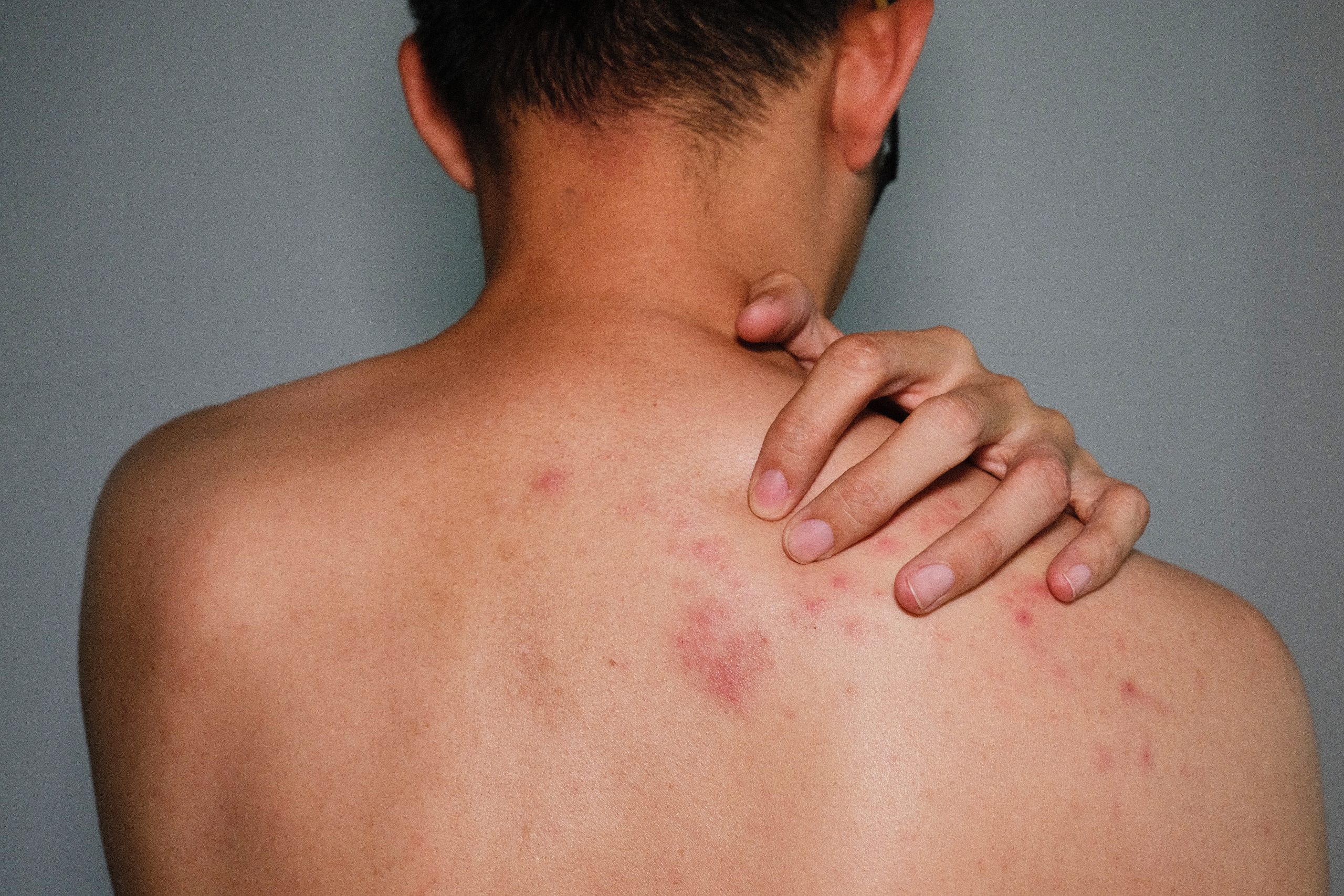 Shingles Awareness Week | Tonic Media Network