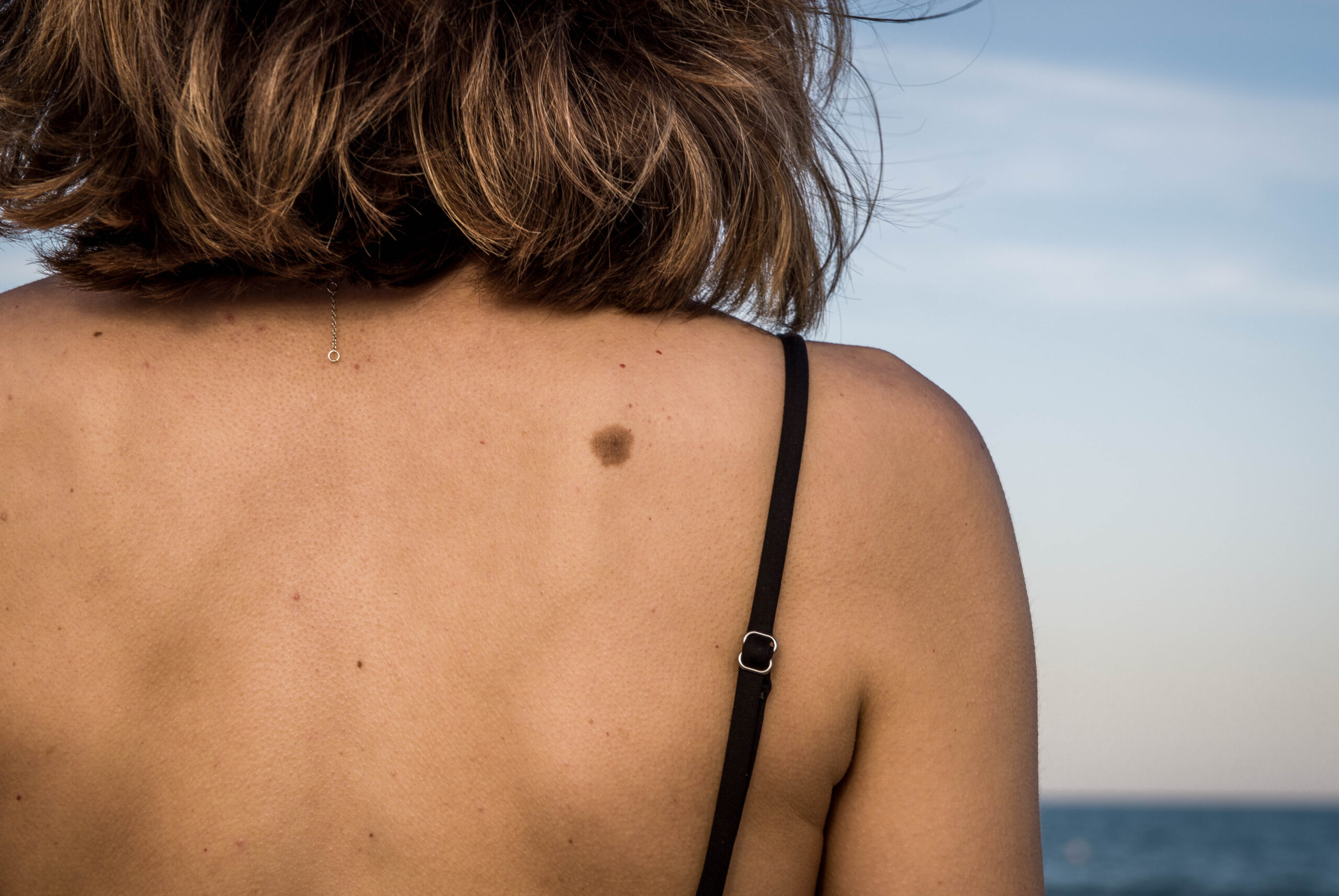 Australians not good at identifying their own melanomas | Tonic Media ...
